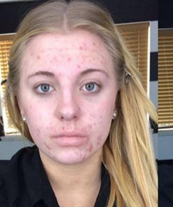 Acne Covered With Makeup Meme | Makeupview.co